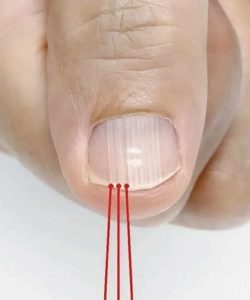 If you have these lines on your nails after 40, it is a clear sign that ...