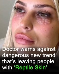 Doctors warn against beauty trend that causes reptile skin – Tiny House ...