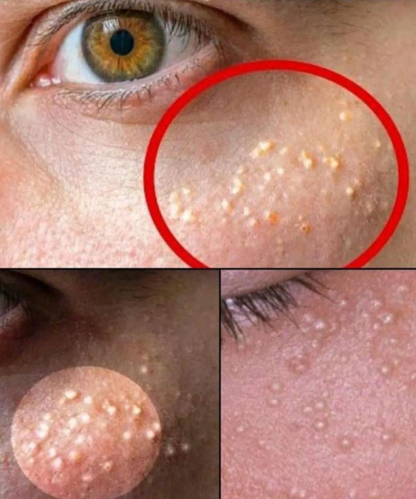 Tiny White Bumps on Your Face? Here’s What They Are—And How to Treat ...