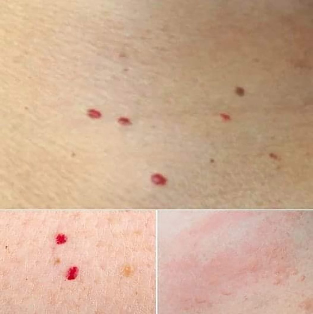 If you notice these red spots on your skin, here’s what they mean ...