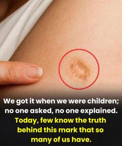 5 Common Misconceptions About the Round Scar on the Upper Arm – Tiny ...